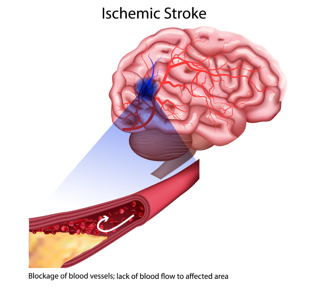 Heart and Stroke Awareness - Be Well Keep Well